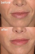 Perlane treatment at our dermatologists office in St. Louis treating ...